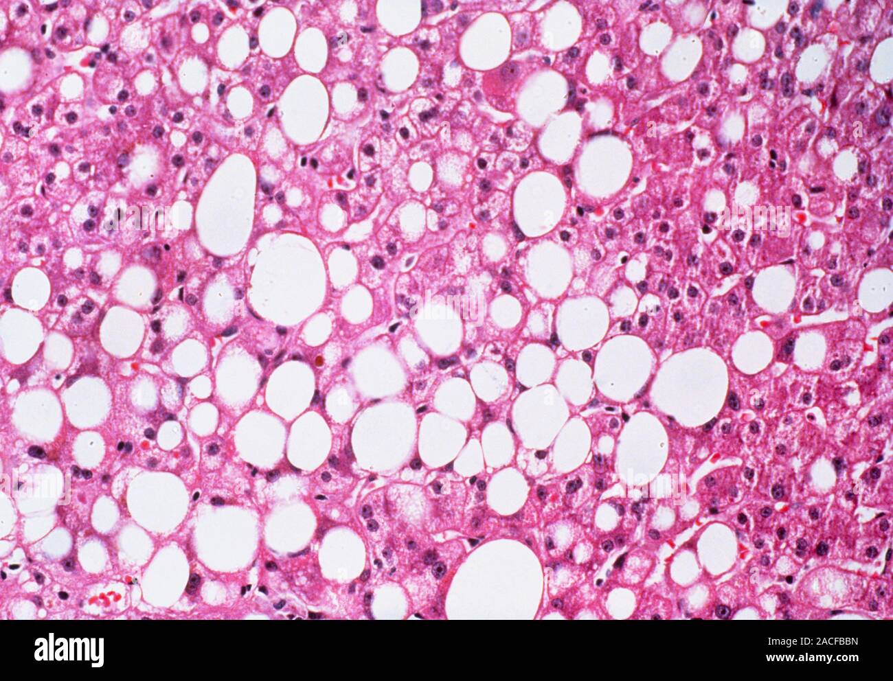 Fatty liver. Light micrograph of fat accumulation (white spaces) in ...