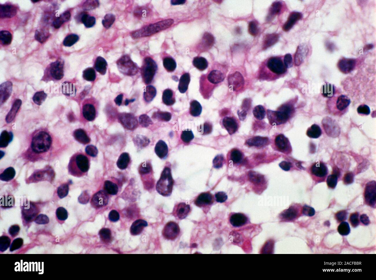 Chronic inflammatory cells. Light micrograph of chronic inflammatory ...