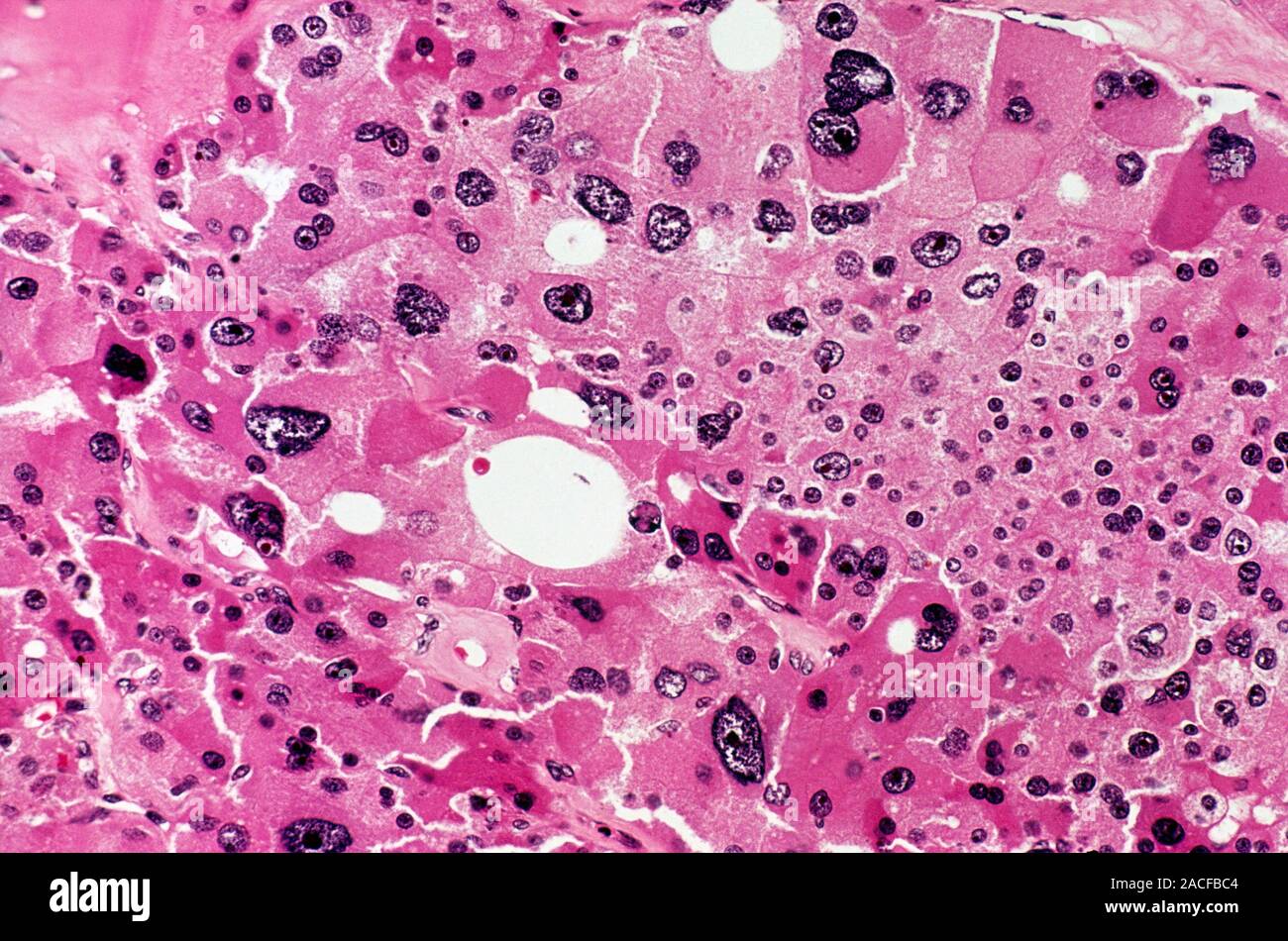 Cancer cells, light micrograph. This sample shows remarkable variation ...