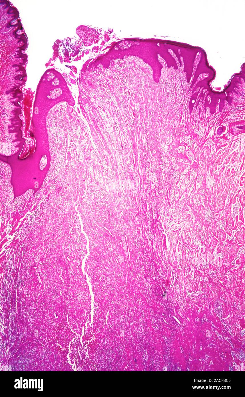 Pilonidal sinus. Light micrograph of tissue from an abscess in a case ...