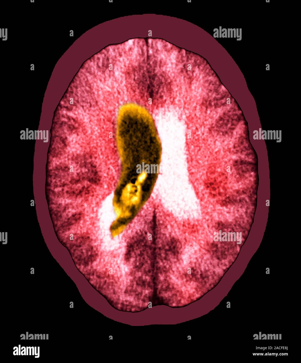 Brain haemorrhage, coloured computed tomography (CT) scan. The front of the brain is at top. A ...