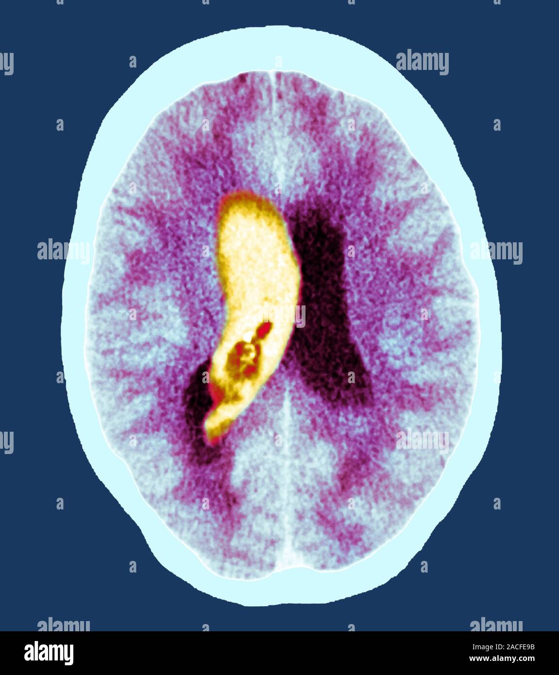 Brain haemorrhage, coloured computed tomography (CT) scan. The front of the brain is at top. A ...