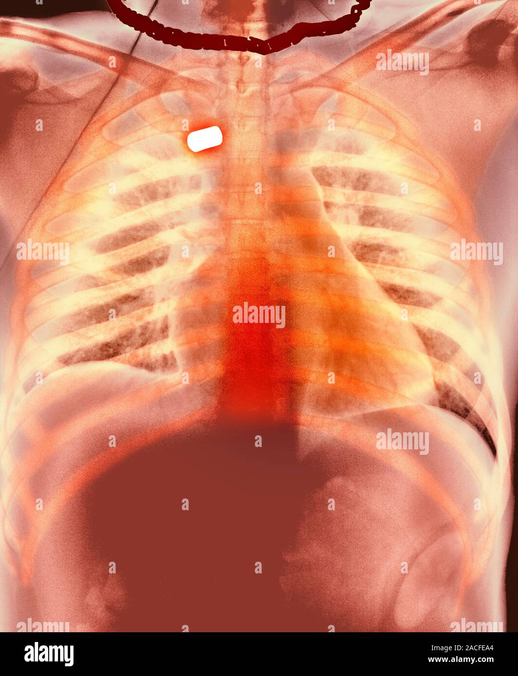 Firearm injury. Coloured X-ray of a bullet (white) embedded in a ...