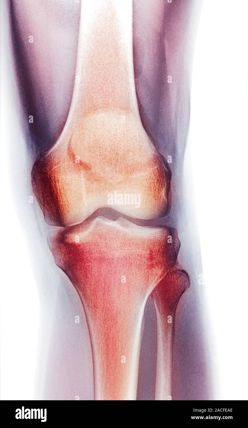 Normal knee, coloured frontal X-ray. The tibia (shin bone, bottom ...