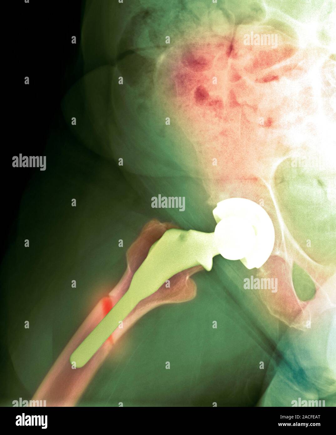 Failed hip resurfacing. Coloured X-ray of failed hip resurfacing in a ...