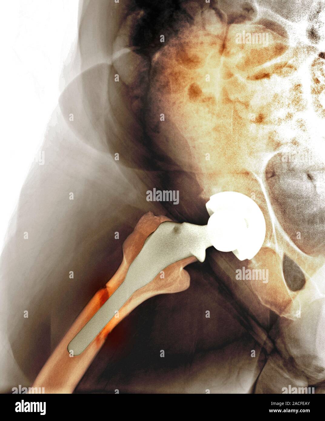 Failed hip resurfacing. Coloured X-ray of failed hip resurfacing in a ...