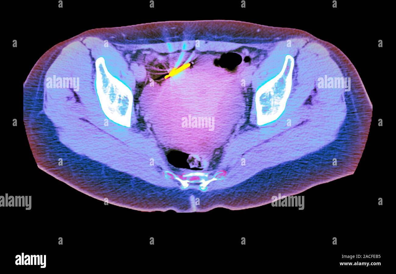 Ectopic IUD contraceptive. Coloured computed tomography (CT) scan of an axial section through ...