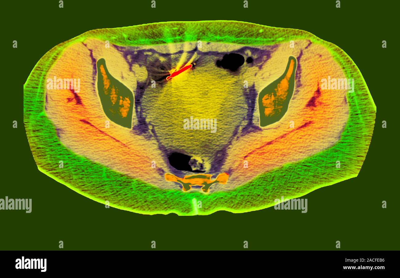 Ectopic IUD contraceptive. Coloured computed tomography (CT) scan of an ...