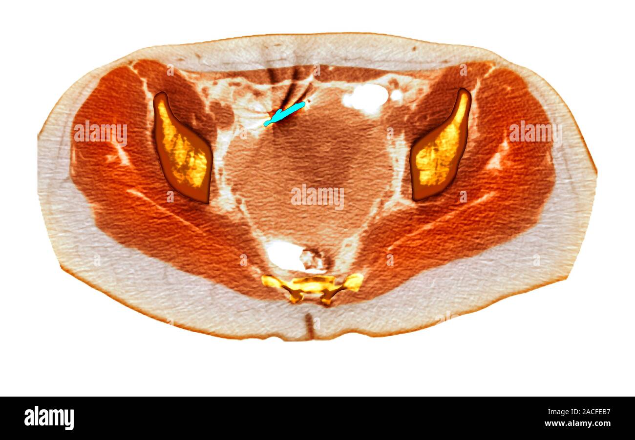 Ectopic IUD contraceptive. Coloured computed tomography (CT) scan of an ...