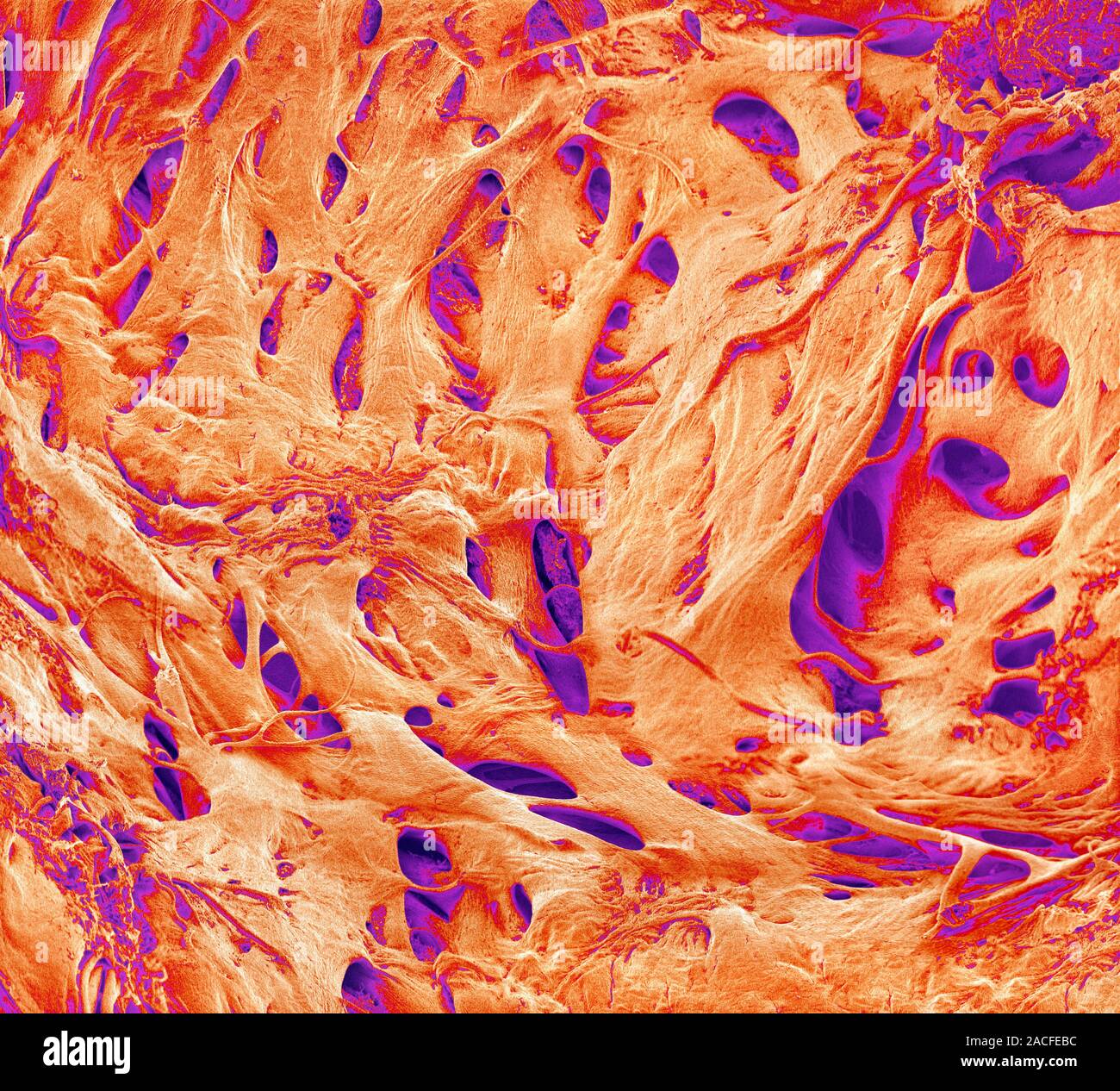 Trabeculae carneae in the left ventricle of the heart, coloured ...