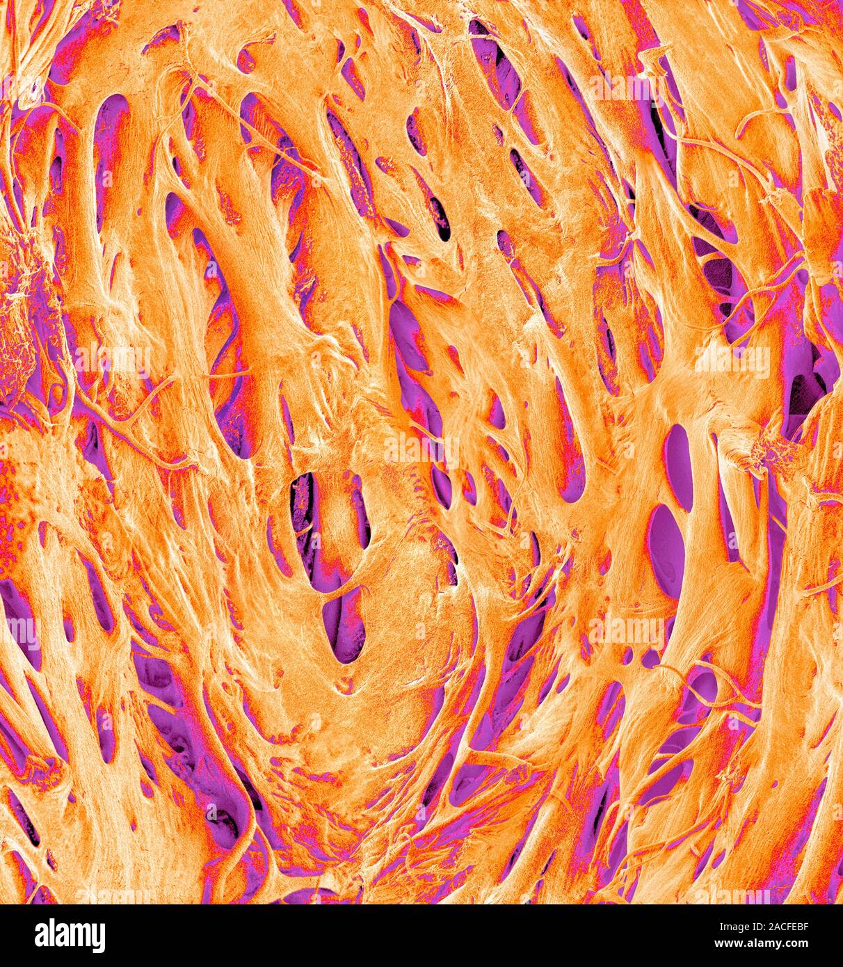 Trabeculae carneae in the left ventricle of the heart, coloured ...