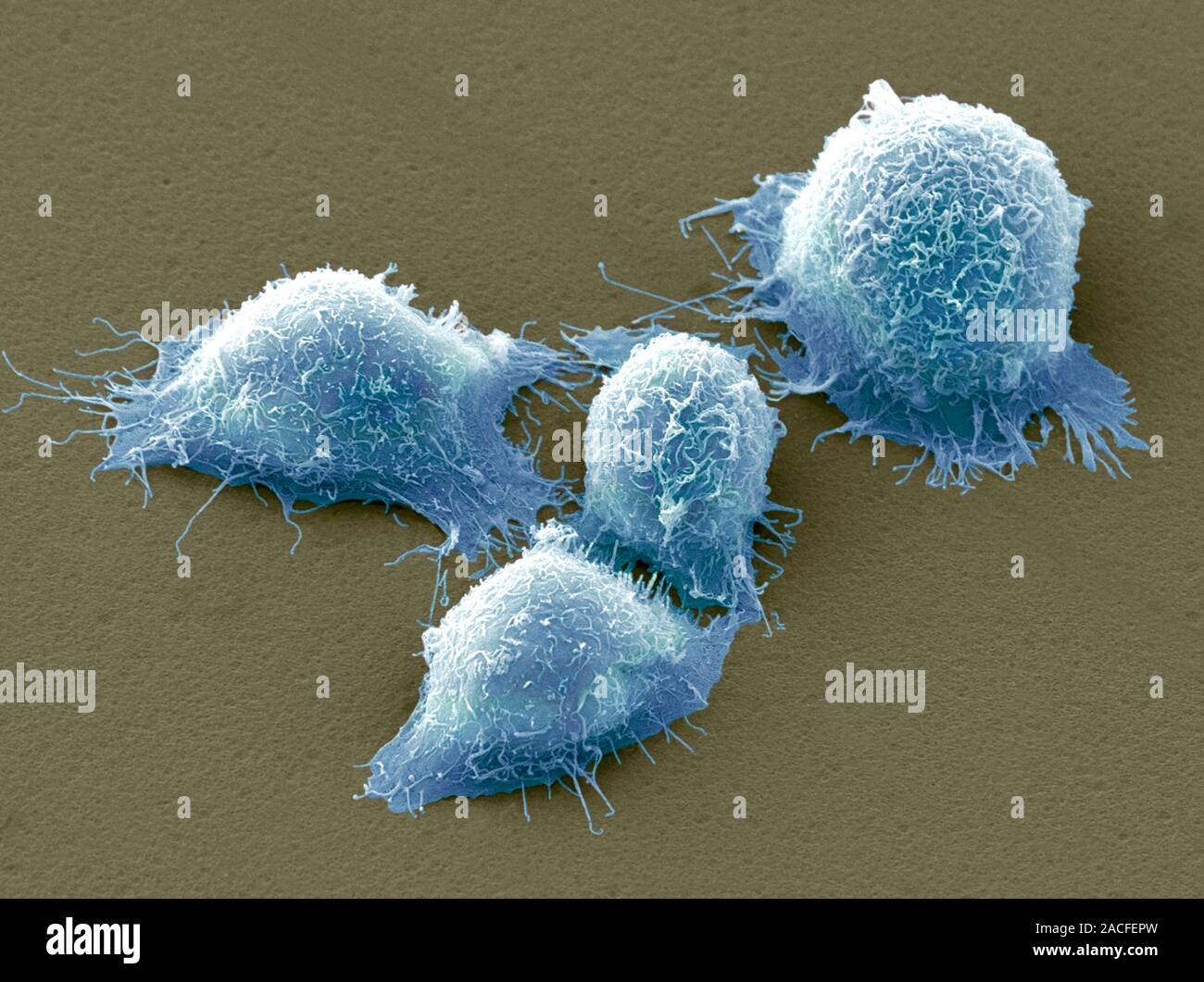 Cervical cancer cells, coloured scanning electron micrograph (SEM ...