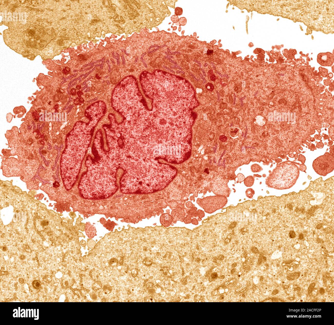 Lung cancer cell, coloured transmission electron micrograph (TEM). This ...