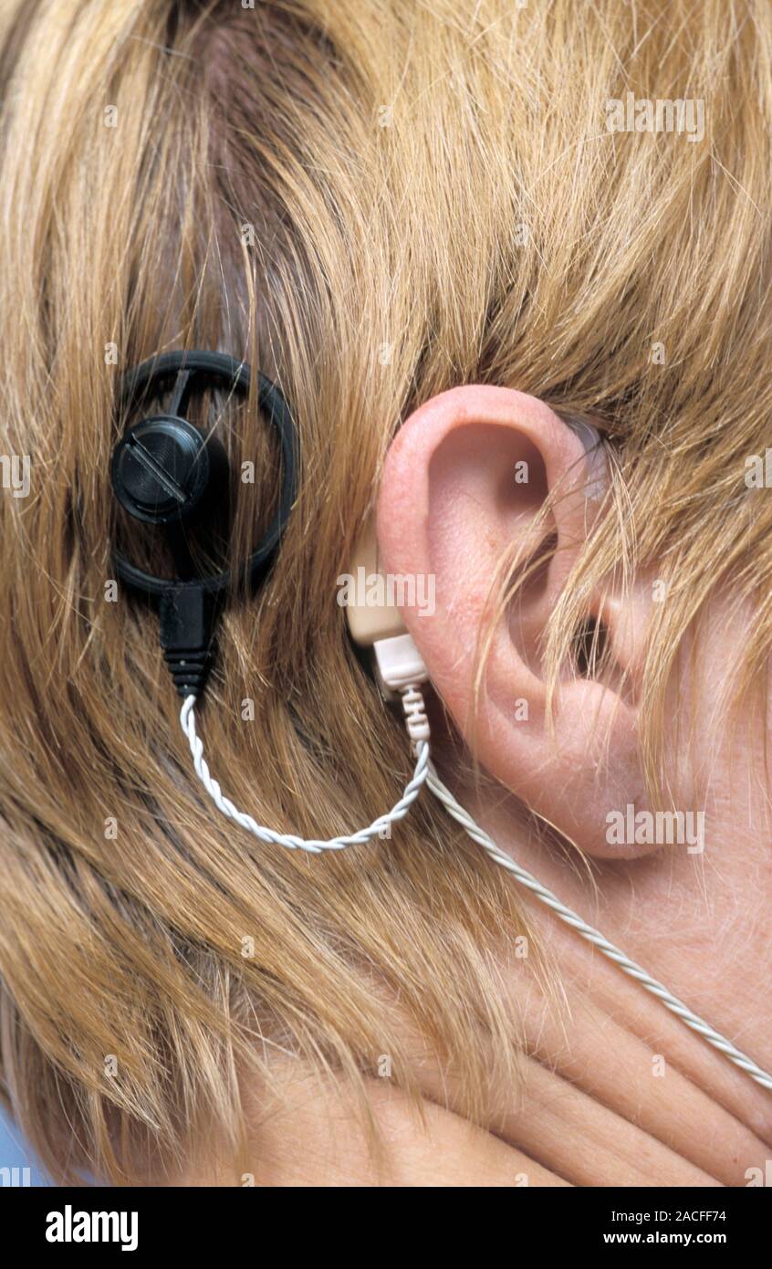 Cochlear implant. Close-up of a cochlear implant being worn by a woman ...
