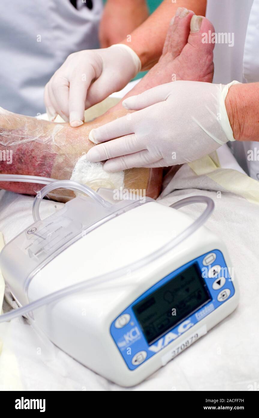 Wound care. Medical professional caring for an open wound on the ankle ...