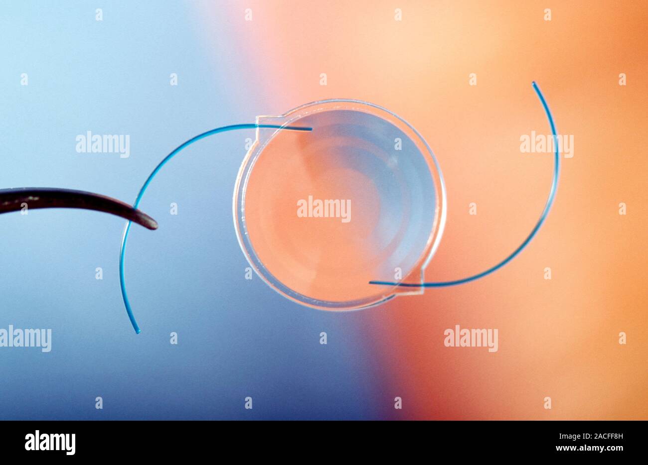 Artificial eye lens, held in a pair of forceps during eye surgery. An ...