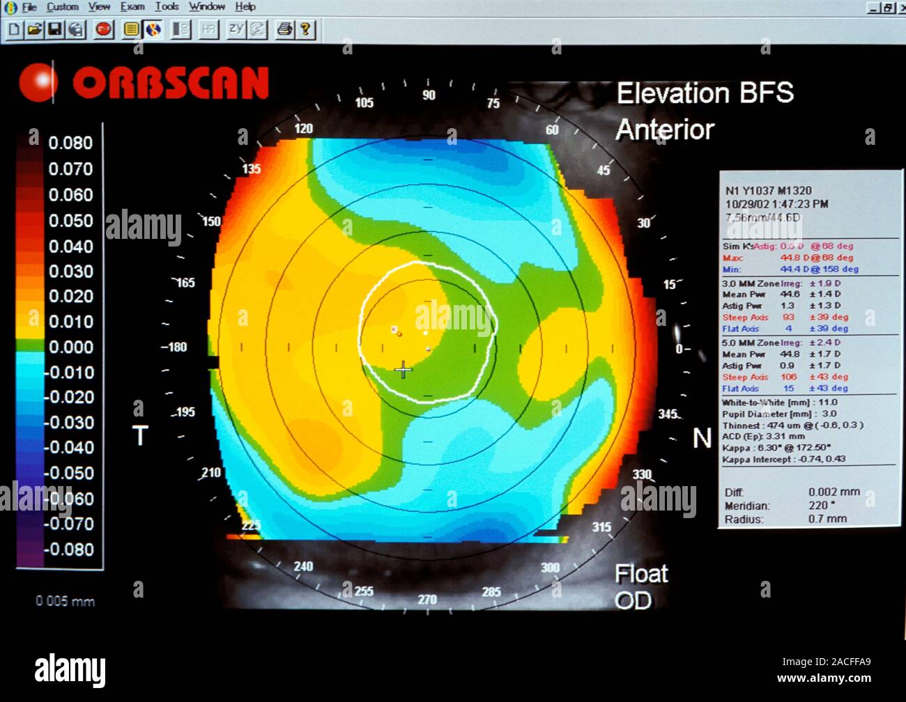 Corneal mapping after laser eye surgery, screenshot. Contour map of the ...