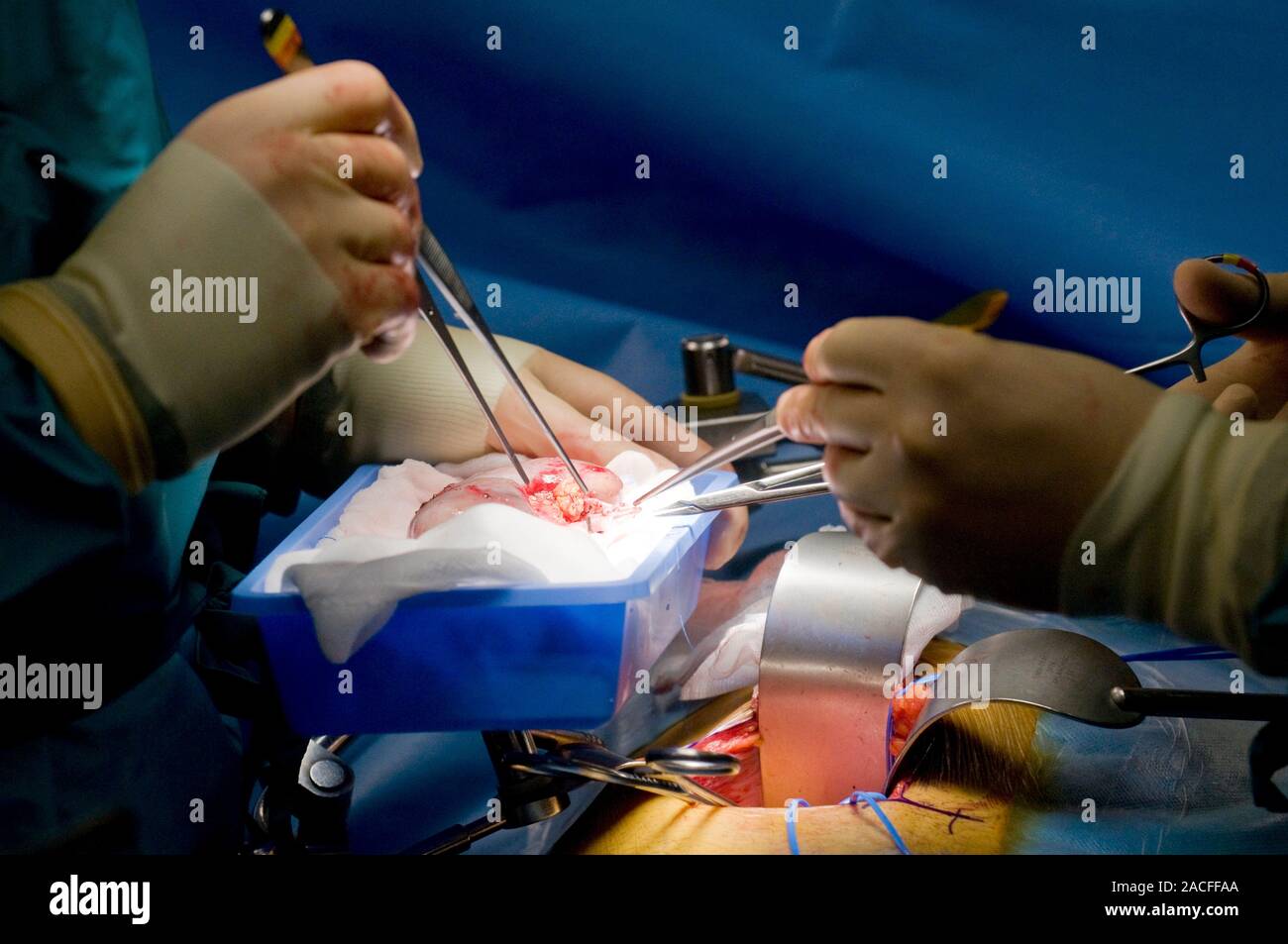 Kidney transplant surgery. Close-up of surgeons with a donor kidney ...