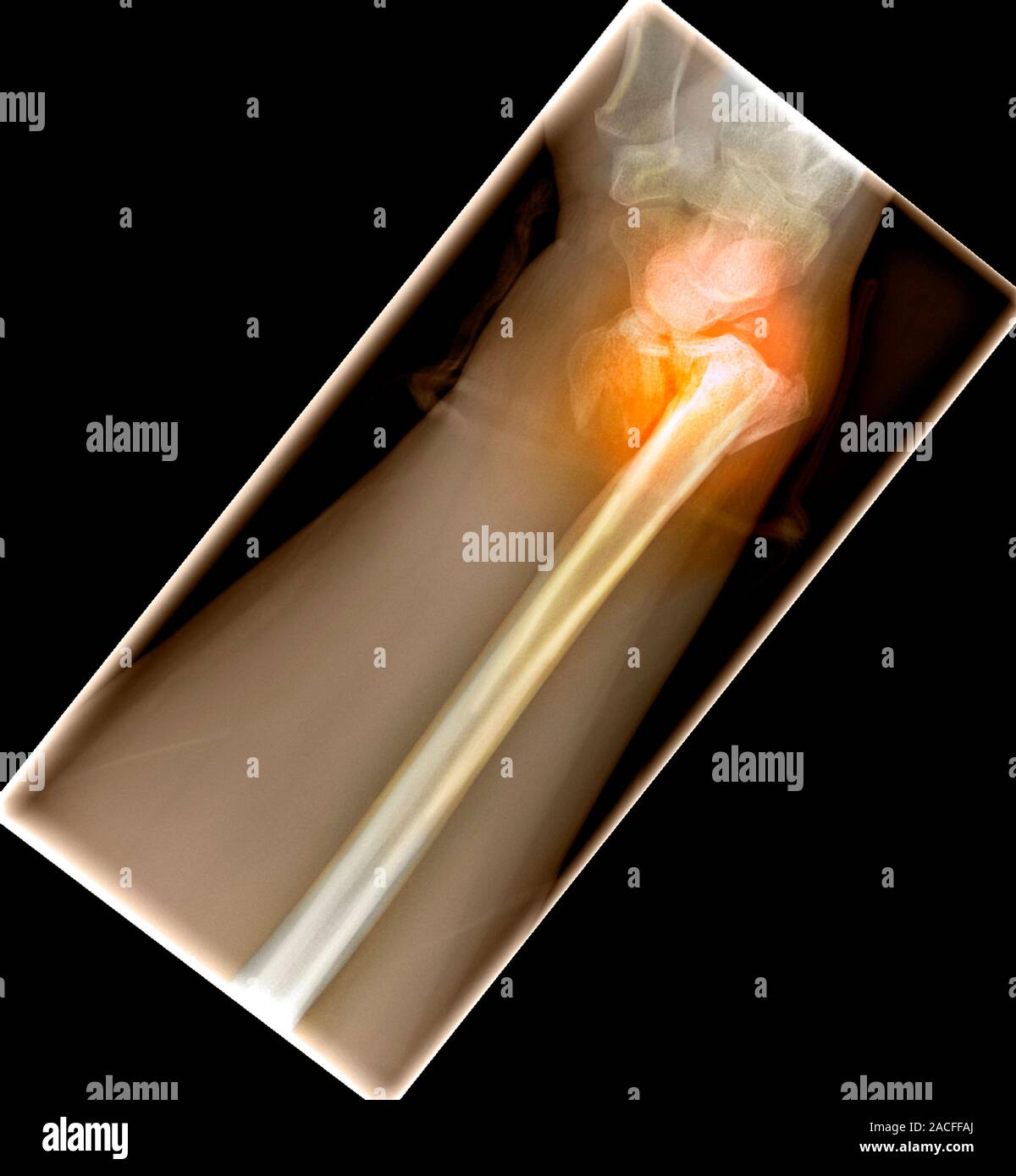 Broken wrist. Coloured X-ray of a comminuted fracture of the distal ...