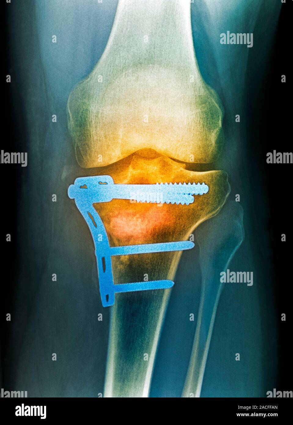 Pinned broken knee. Coloured X-ray of a plate and pins in a broken ...