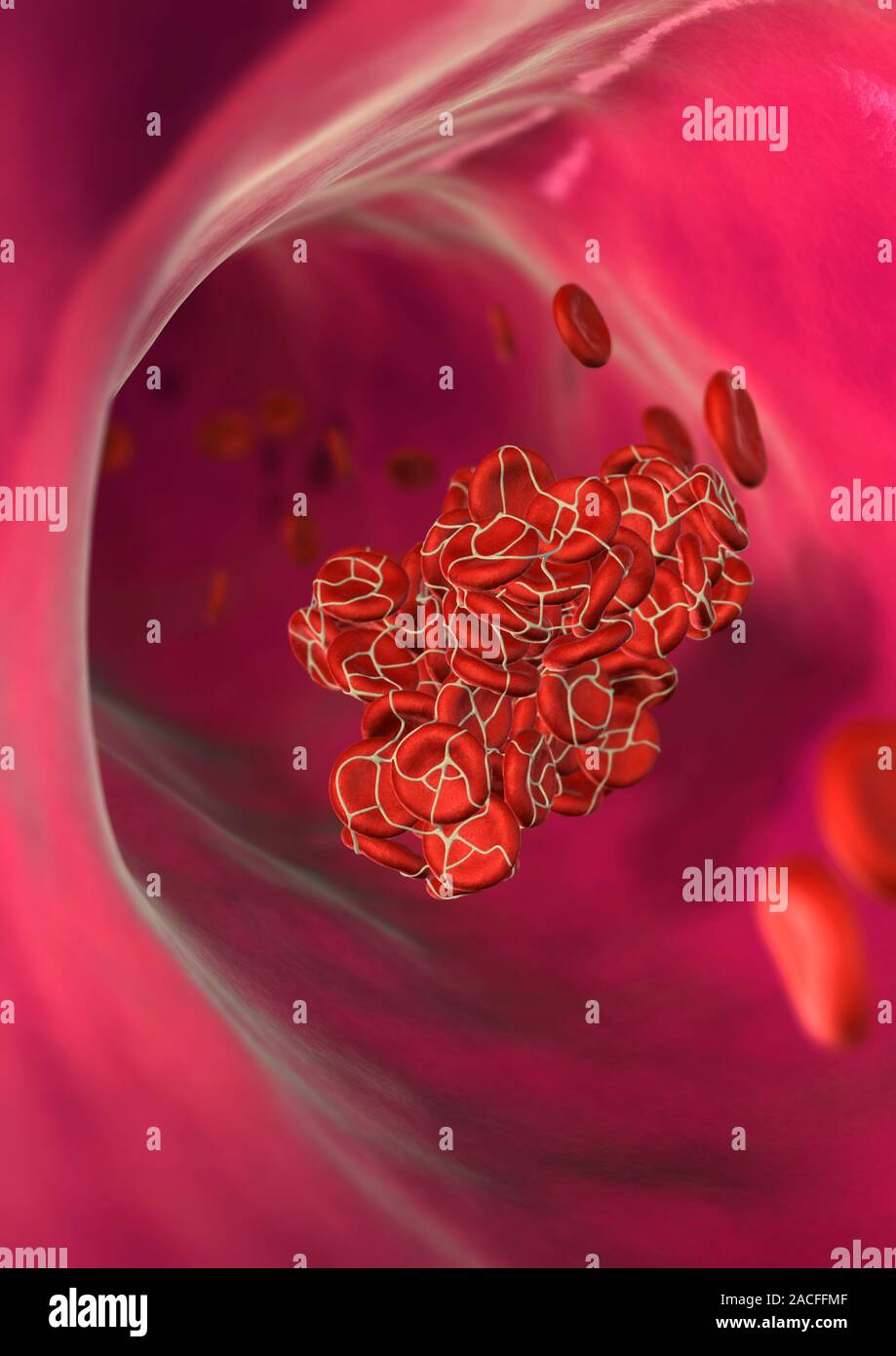 Detached blood clot. Computer artwork of an embolus (detached blood ...