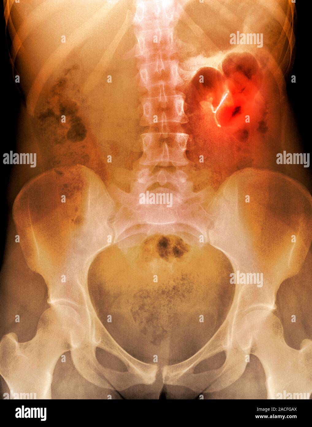 Ectopic IUD contraceptive. Coloured X-ray of the lower abdomen of a ...