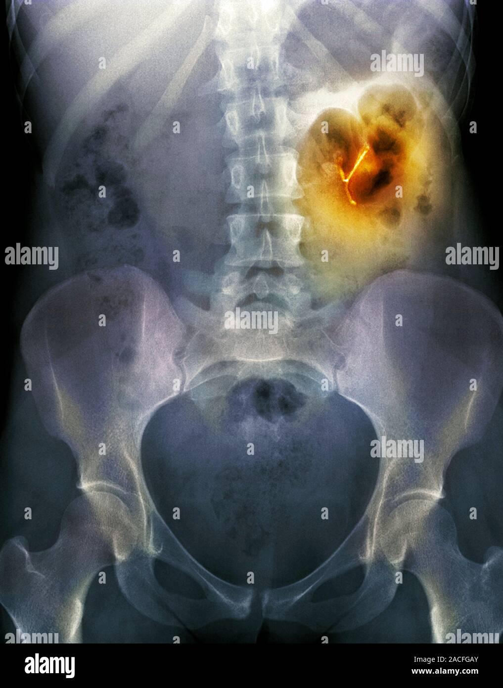 X Ray Images Of Intrauterine Devices On The Case Radiology Today
