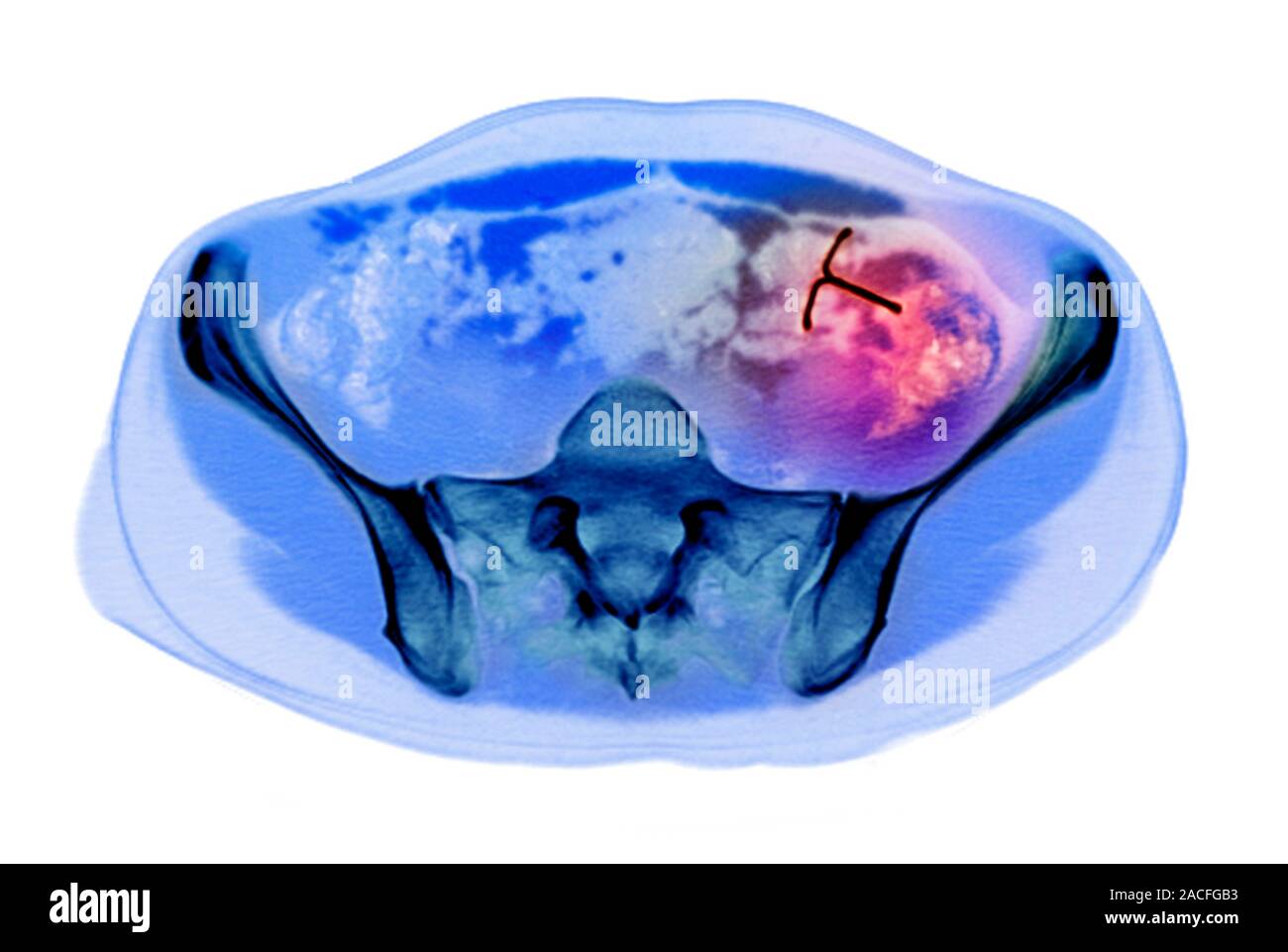 Ectopic IUD contraceptive. Coloured computed tomography (CT) scan of an ...