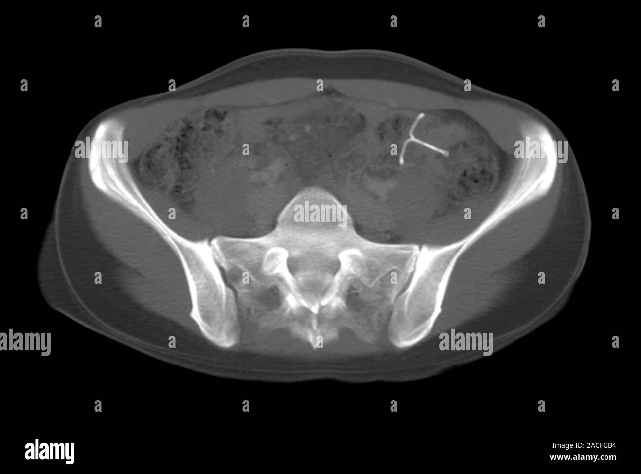 Ectopic IUD contraceptive. Computed tomography (CT) scan of an axial ...