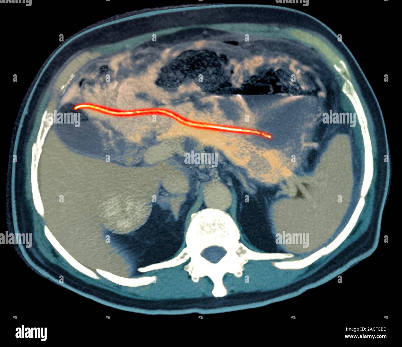 Ectopic pancreatic stent. Coloured computed tomography (CT) scan of an ...