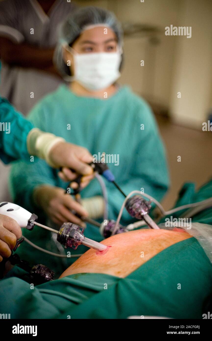 Keyhole surgery. Surgeons using keyhole (laparascopic) surgery to ...