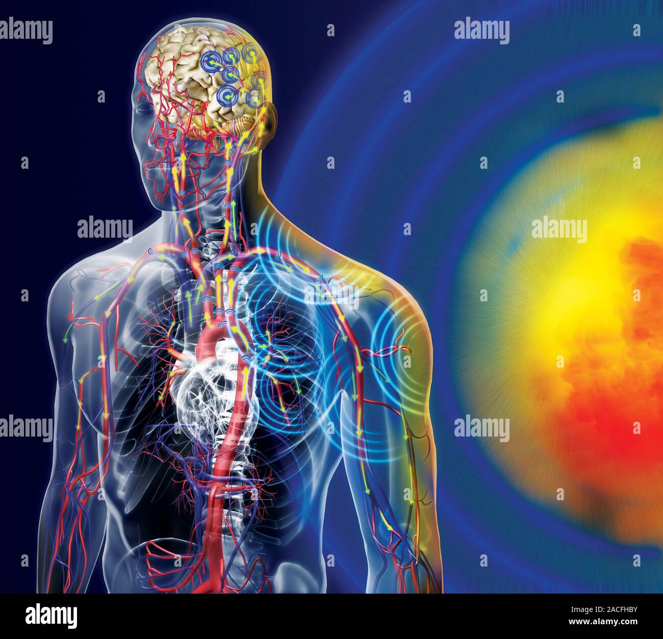 Blast injuries. Artwork showing the external and internal effects on ...