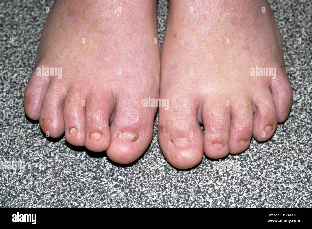 Epidermolysis bullosa. Feet of a five year old girl with epidermolysis ...