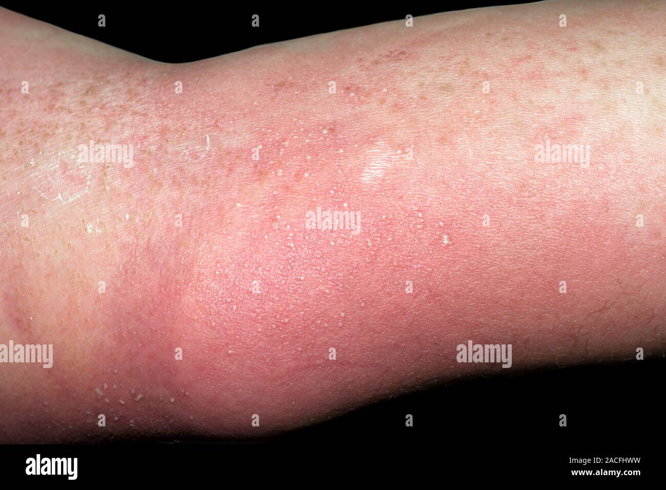 Allergic rash on the arm of a middle aged woman. This response was ...