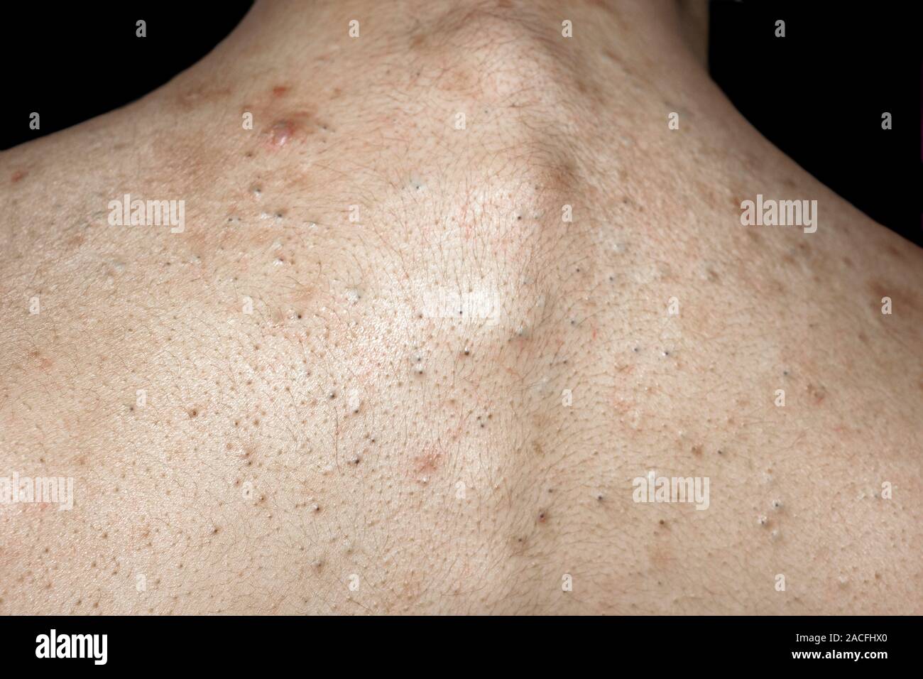 Acne Vulgaris Back Of Head