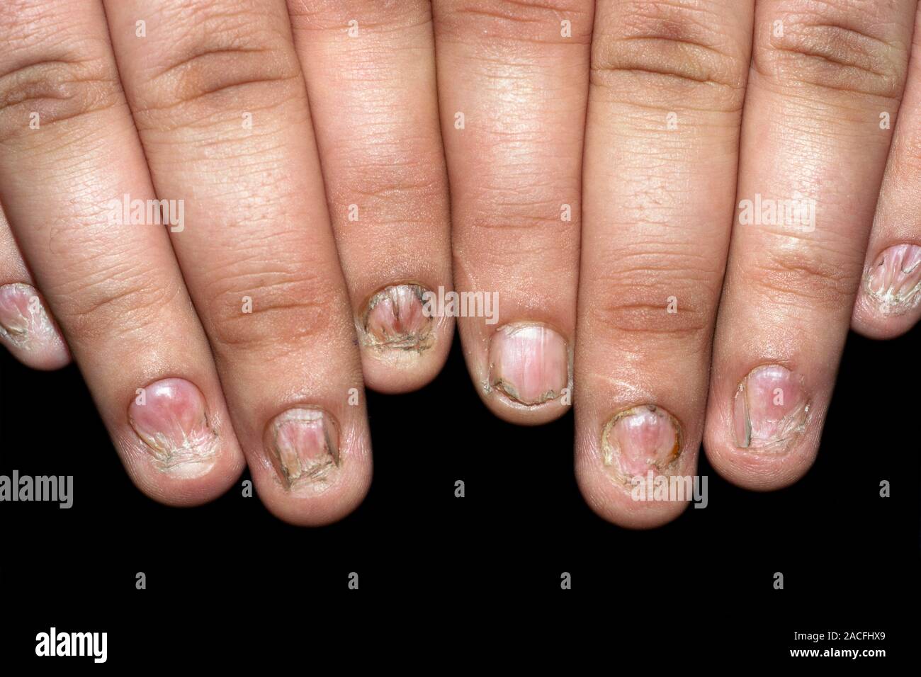 Fungal nail infection. Fingernails of a young man with onychomycosis ...