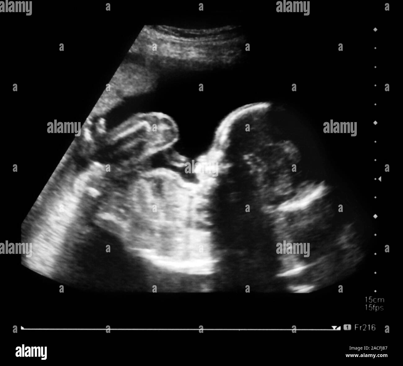 Foetus at 20 weeks, ultrasound scan Stock Photo - Alamy