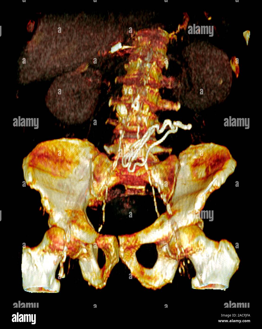 Retained surgical swab. Coloured 3D magnetic resonance imaging (MRI ...