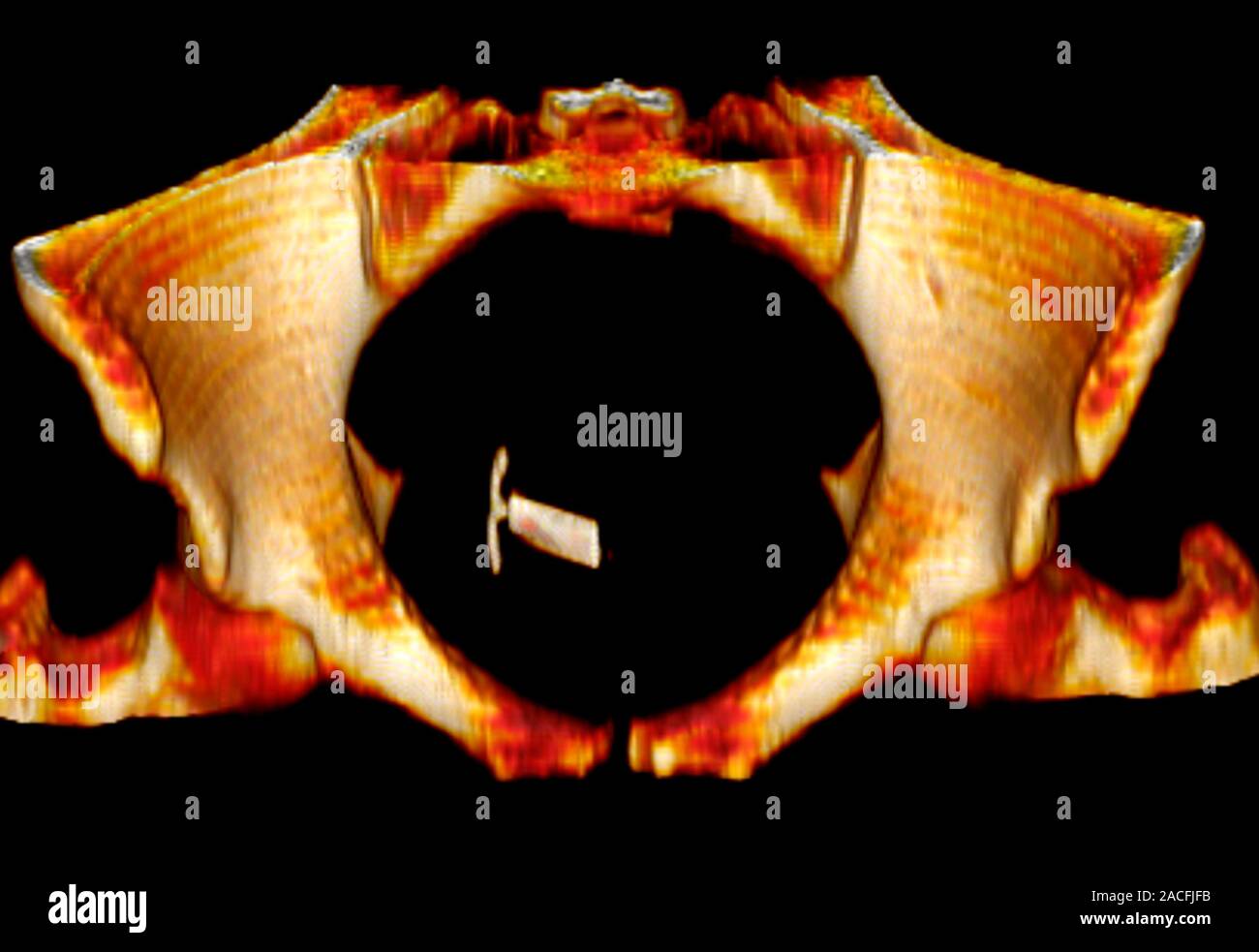 Ectopic IUD contraceptive. Coloured 3D magnetic resonance imaging (MRI ...