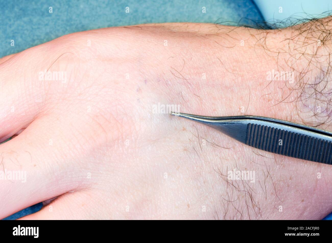 Excision biopsy. Close-up of the back of a man's hand with forceps ...