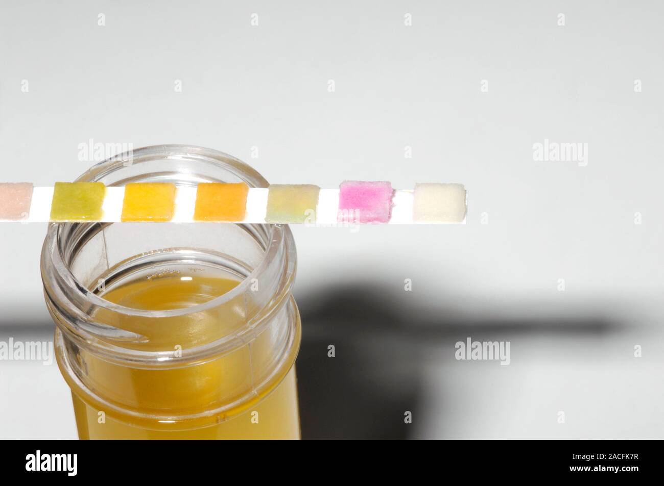 Urine analysis. Urine sample with a test strip showing the results ...