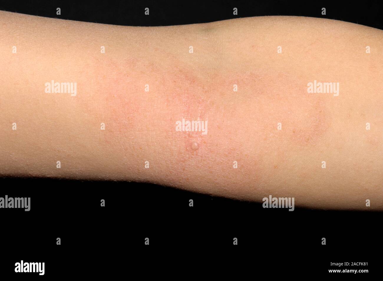 Dermatitis affecting the skin on the arm of a six year old boy ...