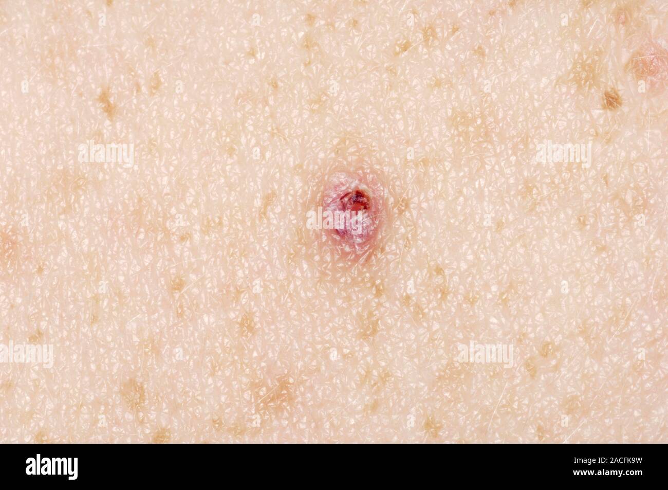 Dermatofibroma on the shoulder of a 20 year old man. A dermatofibroma ...