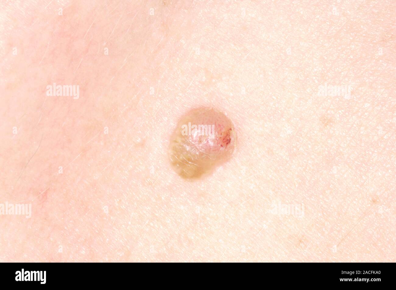 Seborrhoeic wart on a 25 year old woman's skin. This is a benign (non ...