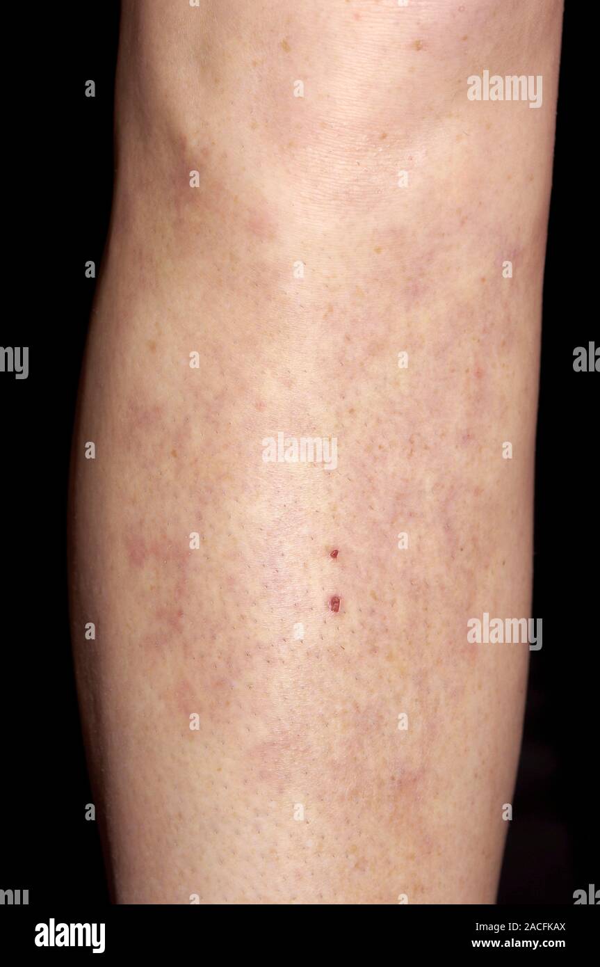 Nodular vasculitis rash (red patches) on a 38 year old womans's legs ...