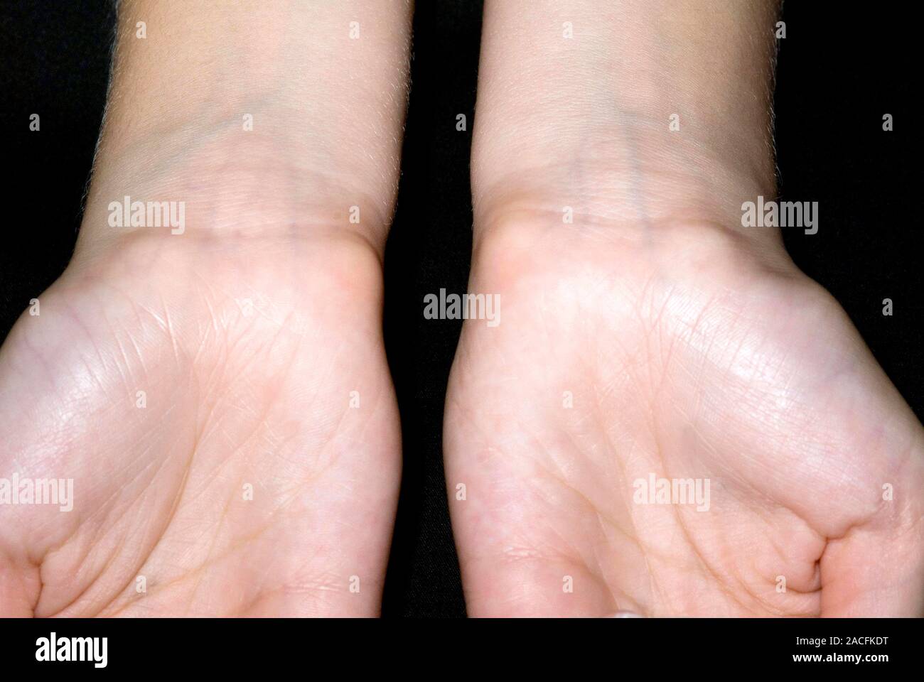 Prominent wrist bones of an 11 year old girl. This is not a deformity ...