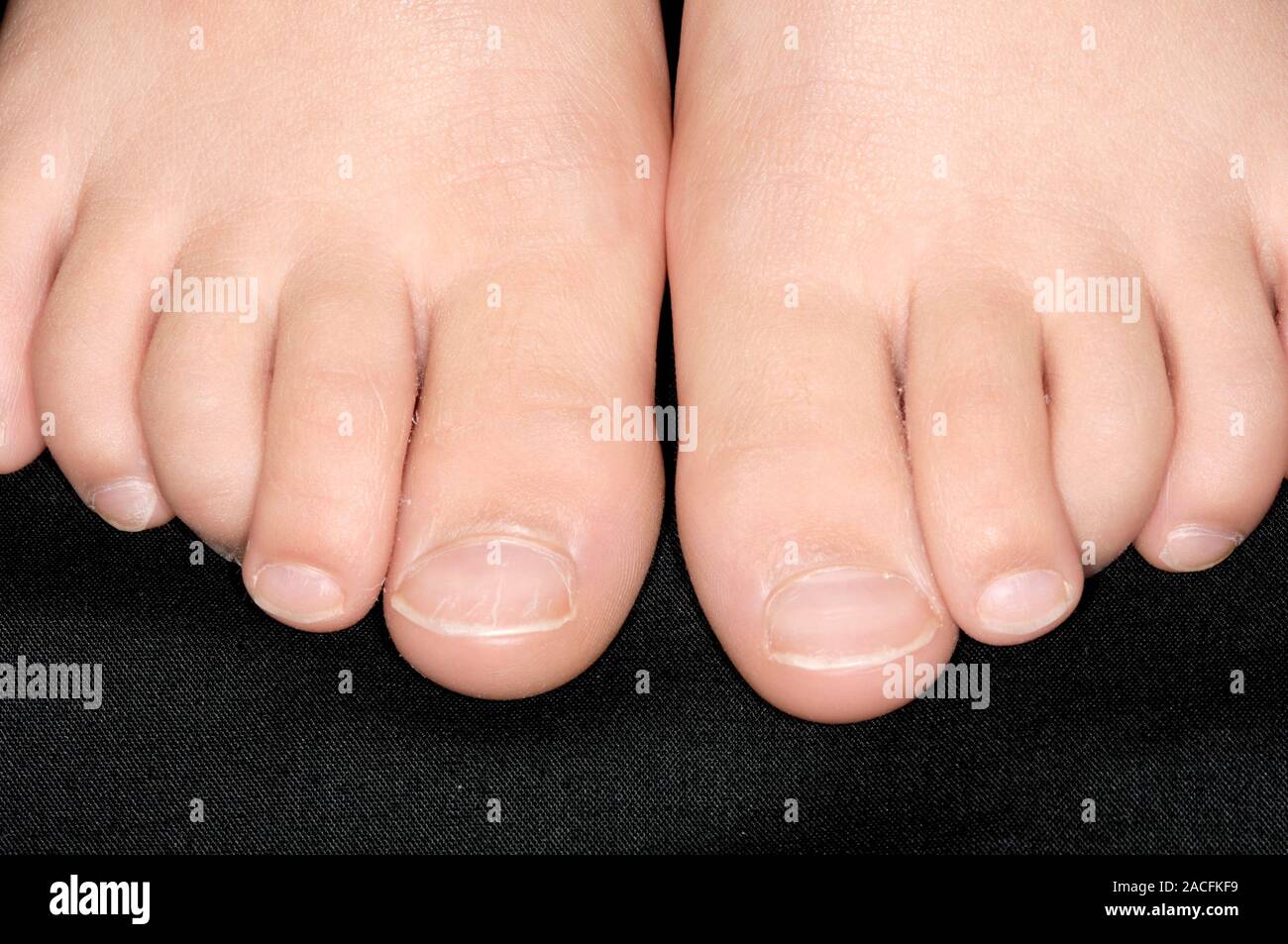 Curly toes. 5 year old girl with a curly middle toe on each foot. Curly ...