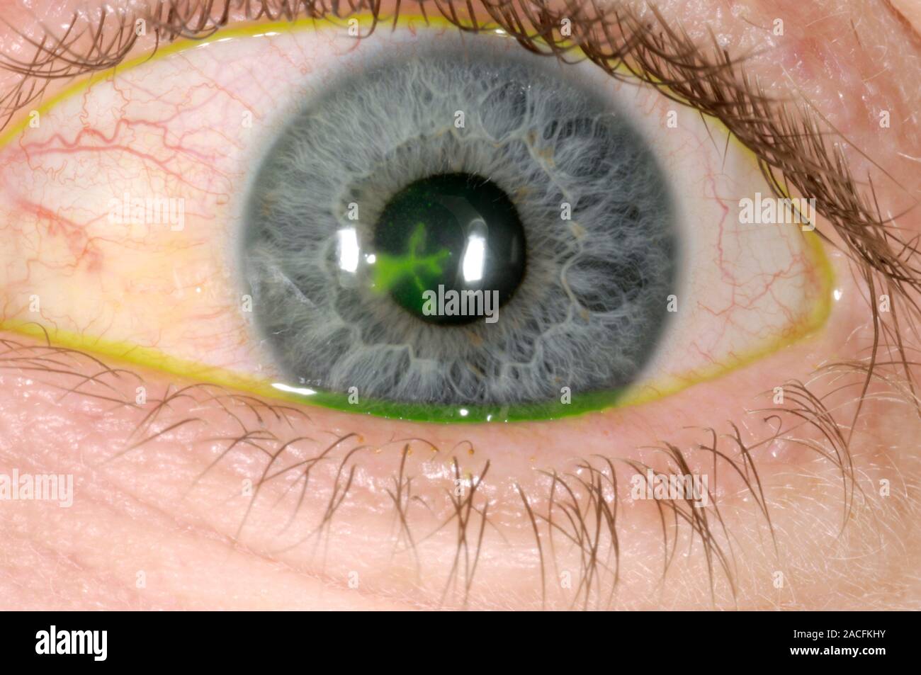 Eye ulcer. Dendritic (branching) ulcer (green) on the cornea of a 32 ...