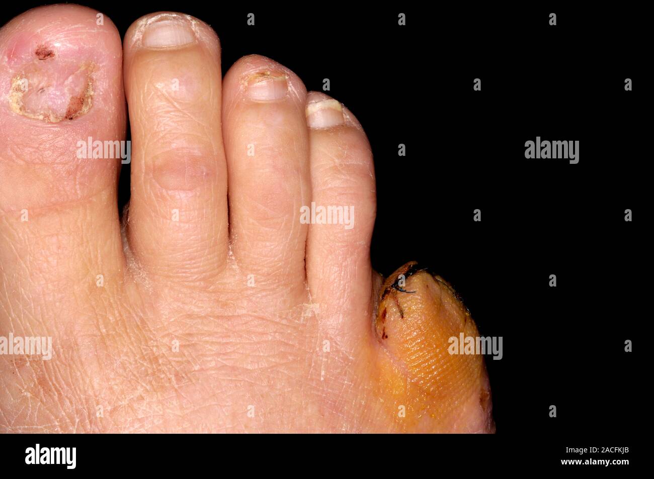 Amputated toe. Foot of a 40 year old woman with an amputated fifth toe ...