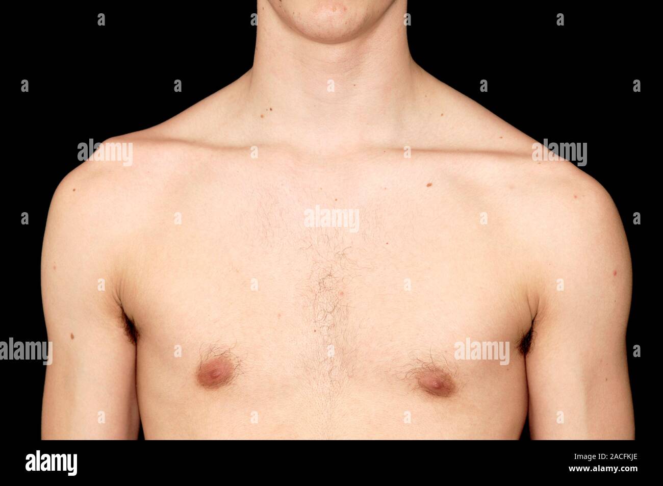 Partially dislocated shoulder joint. Torso of a 19 year old man showing ...